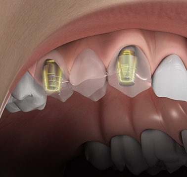 Componenti Protesiche Implantologia E Chirurgia Protesi Implantare ...